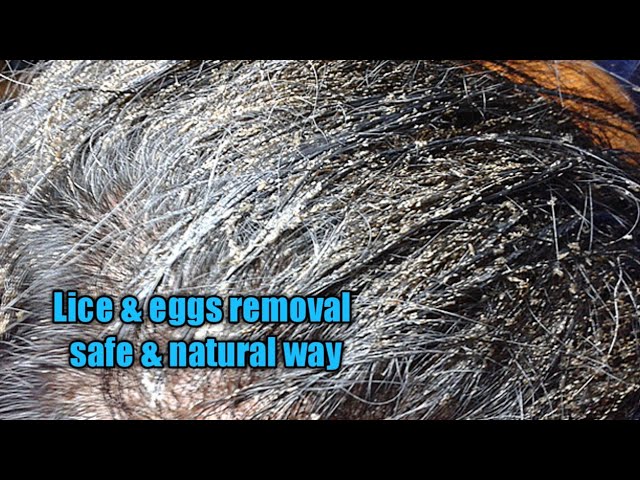 Head Lice Eggs Vs Dandruff Lice Vs Dandruff 7 Key Differences 6360
