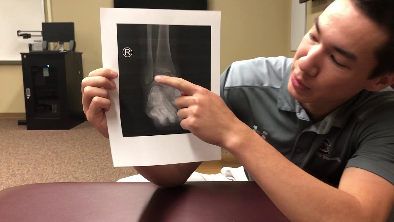 Reading an X-Ray - YouTube