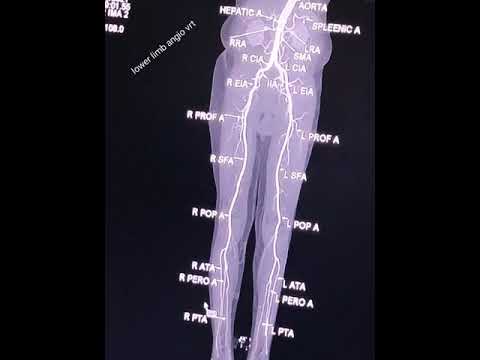 LOWER LIMB ANGIO VRT AND LABELING... IN CT ANGIOGRAPHY.....#RADIOLOGY ...