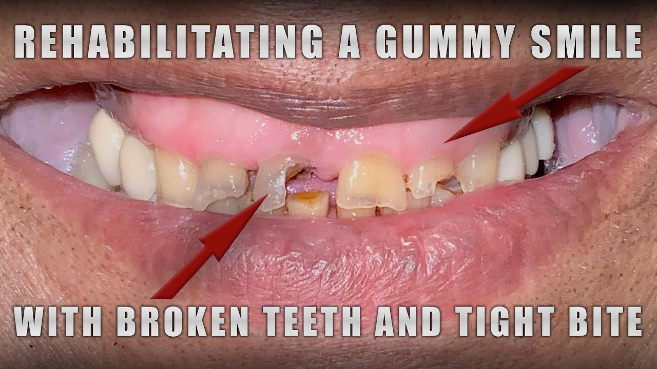 Rehabilitating a Gummy Smile with Broken Teeth and Tight Bite - YouTube