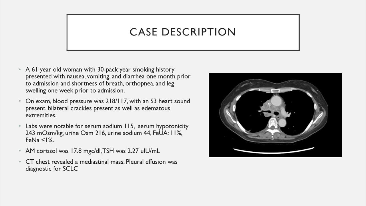 Syndrome Of Inappropriate Antidiuresis Due To Reset Osmostat In Small syndrome-of-inappropriate-antidiuresis-due-to-reset-osmostat-in-small