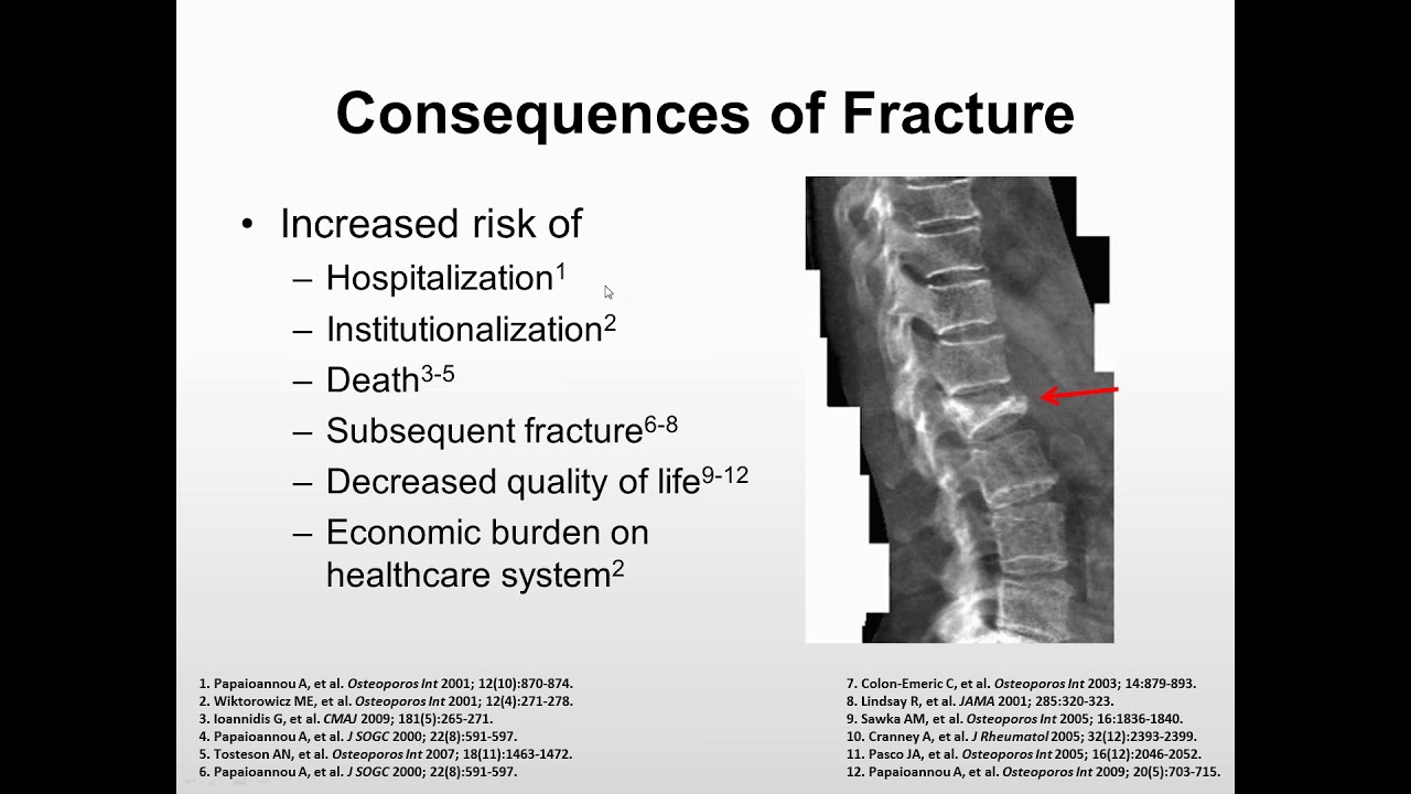 Fracture Risk Assessment: From Basics to Baffling - YouTube