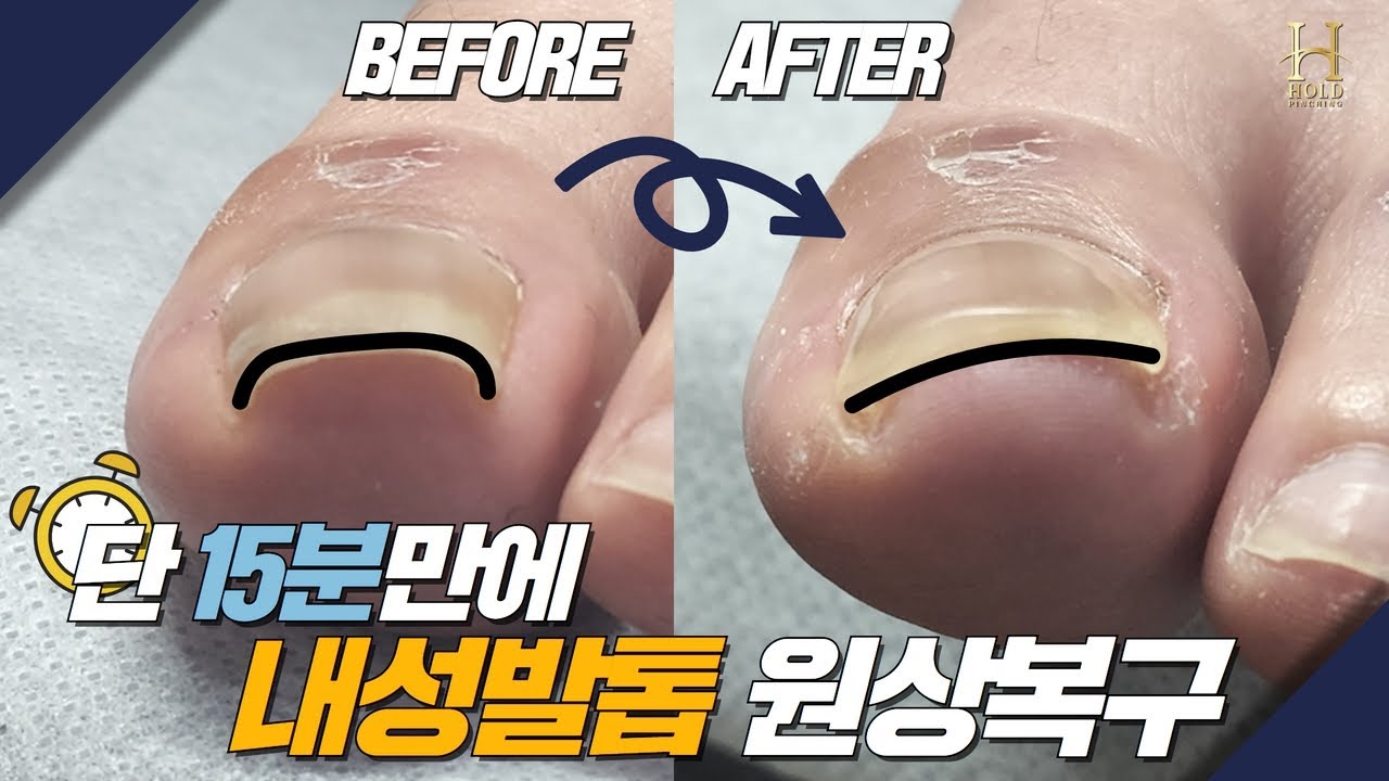[특허관리] 평생 고민 내성발톱, 단 15분만에 해결 / Resolve bent toenail in 15 minutes ...