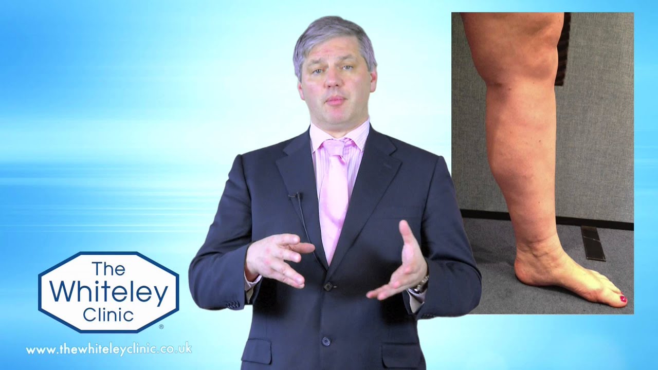 CEAP Classification - C3: Swollen ankles (oedema) due to varicose veins ...