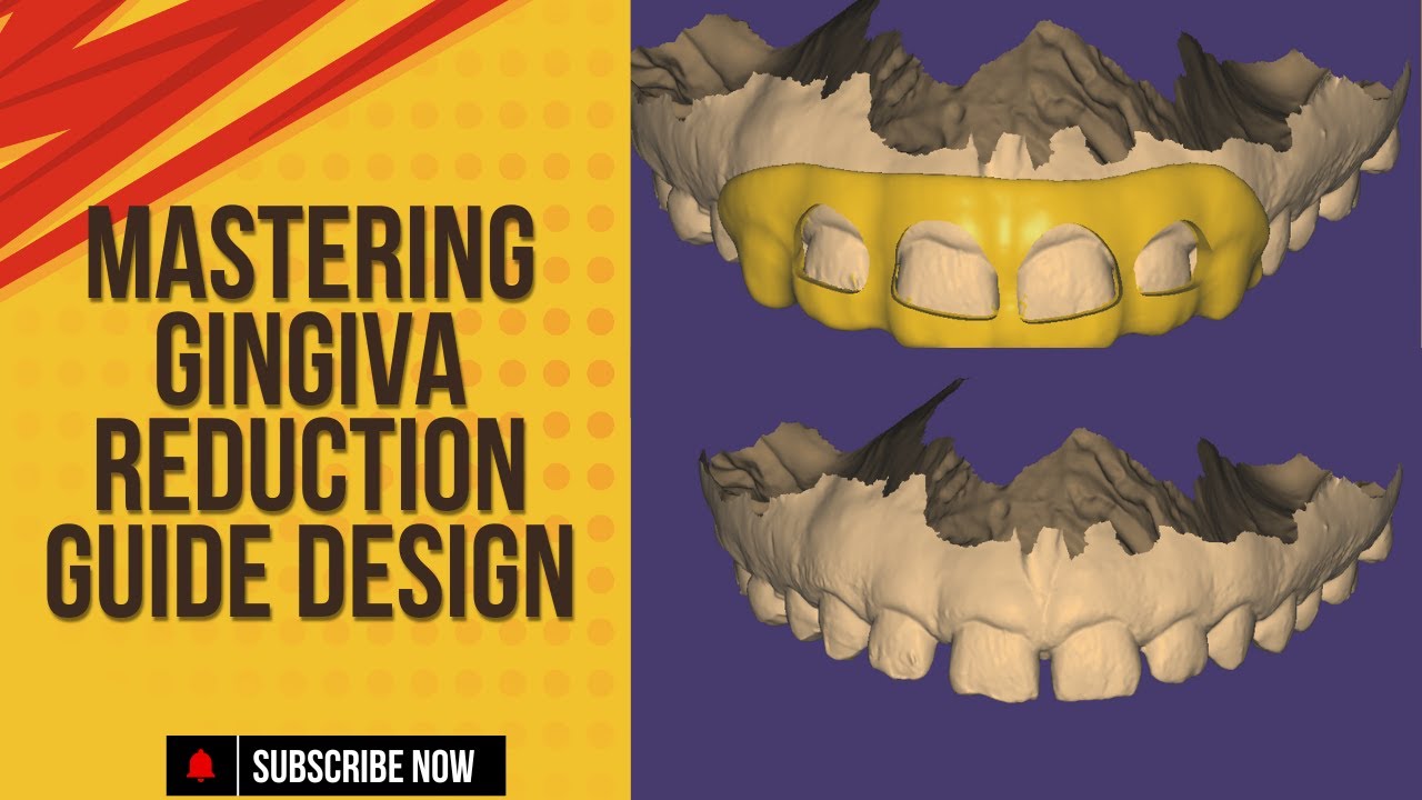 Mastering Gingiva Reduction Guide Design in #exocad Step by Step ...