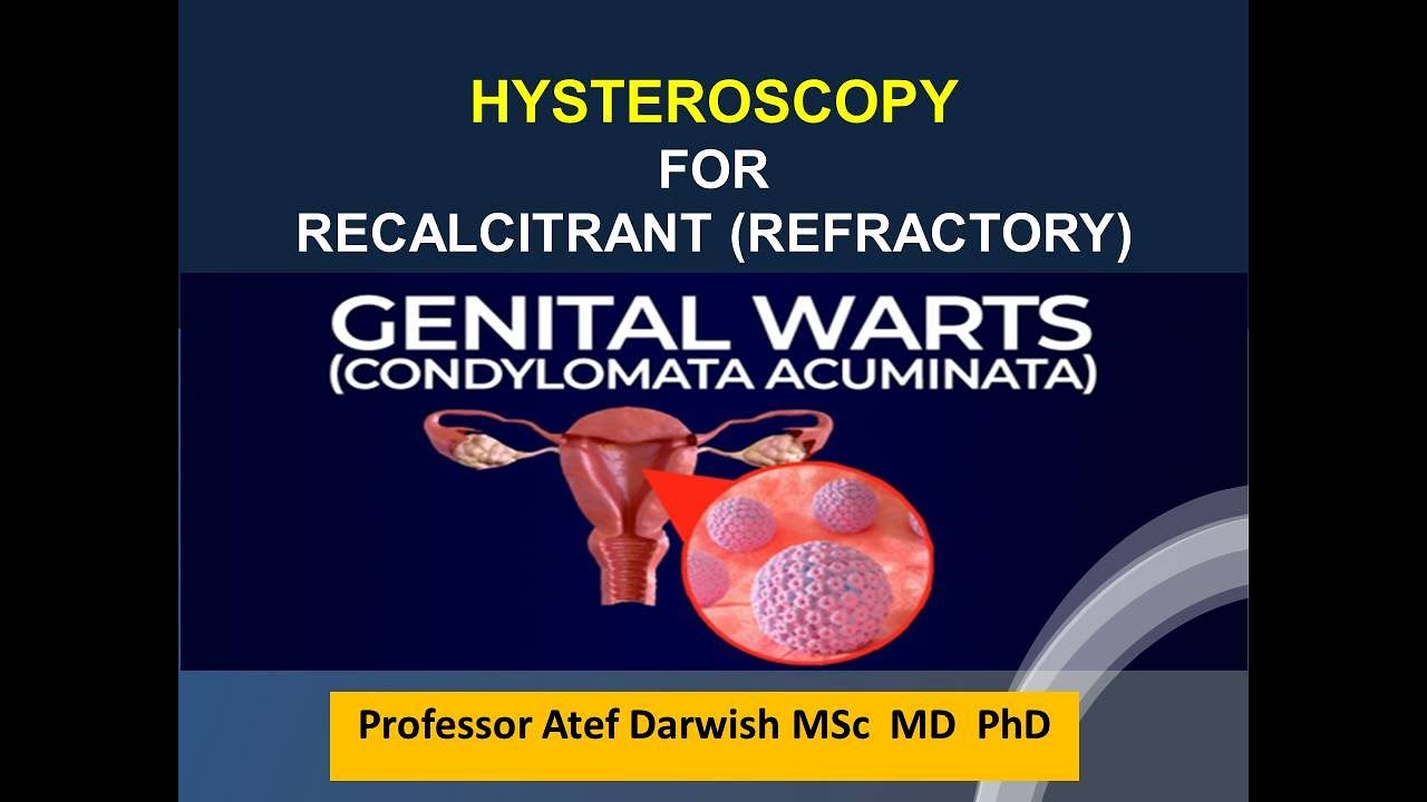 Hysteroscopy for refractory (recalcitrant) condyloma accuminata - YouTube