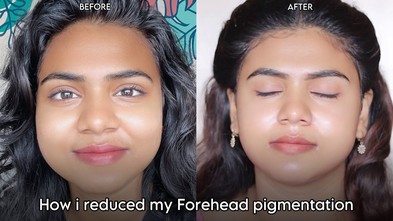 How I Reduced My Forehead Pigmentation with Pond's Anti-Pigmentation ...