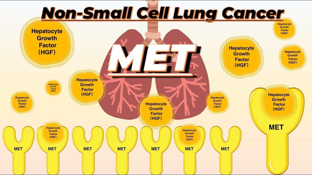 MET｜Popular Gene Target of Lung Cancer Research - YouTube