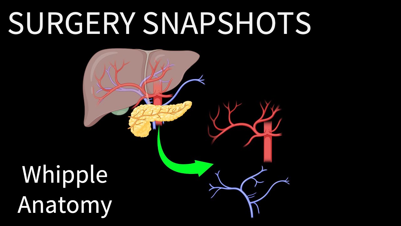 Critical Anatomy for the Whipple Procedure - YouTube