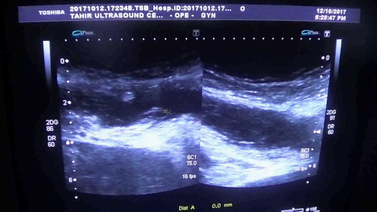 subcutaneous abscess post C / S - YouTube