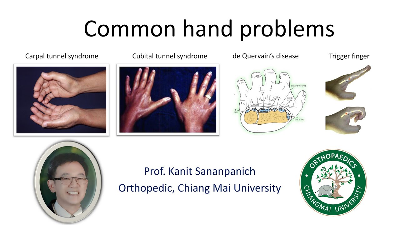 Common hand problems by Dr.Kanit Sananpanich - YouTube