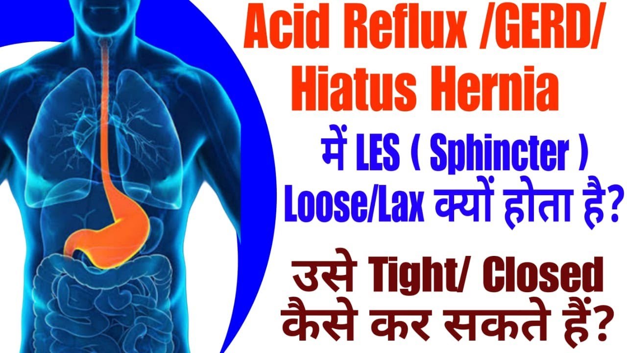 Acid Reflux GERD Hiatus Hernia में LES(Sphincter) Loose क्यों होता है ...