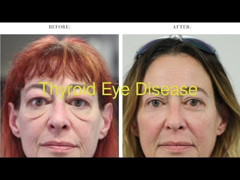 what is Thyroid Eye Disease? How to treat Hyperthyroidism.. Health ...