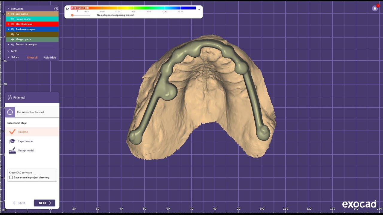 Upper titanium bar designing for single piece basal implant in exocad ...