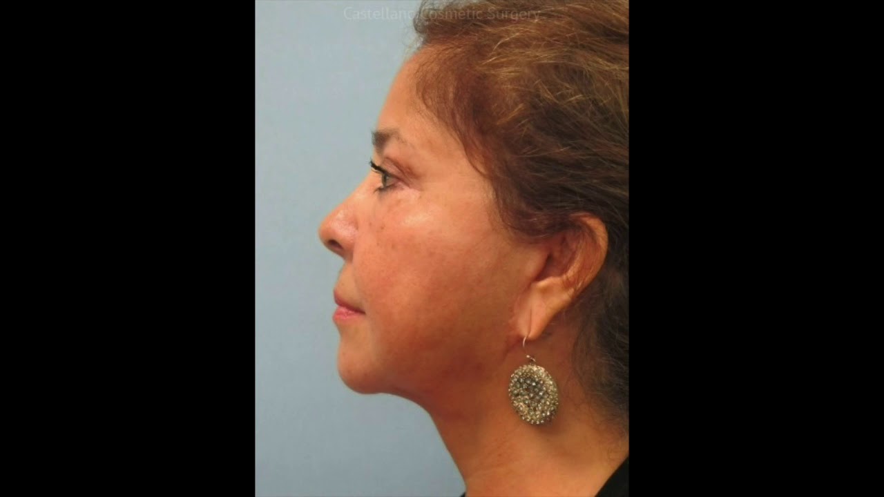 Dr. Joseph Castellano | Before & After Video: Facelift Case #137 - YouTube