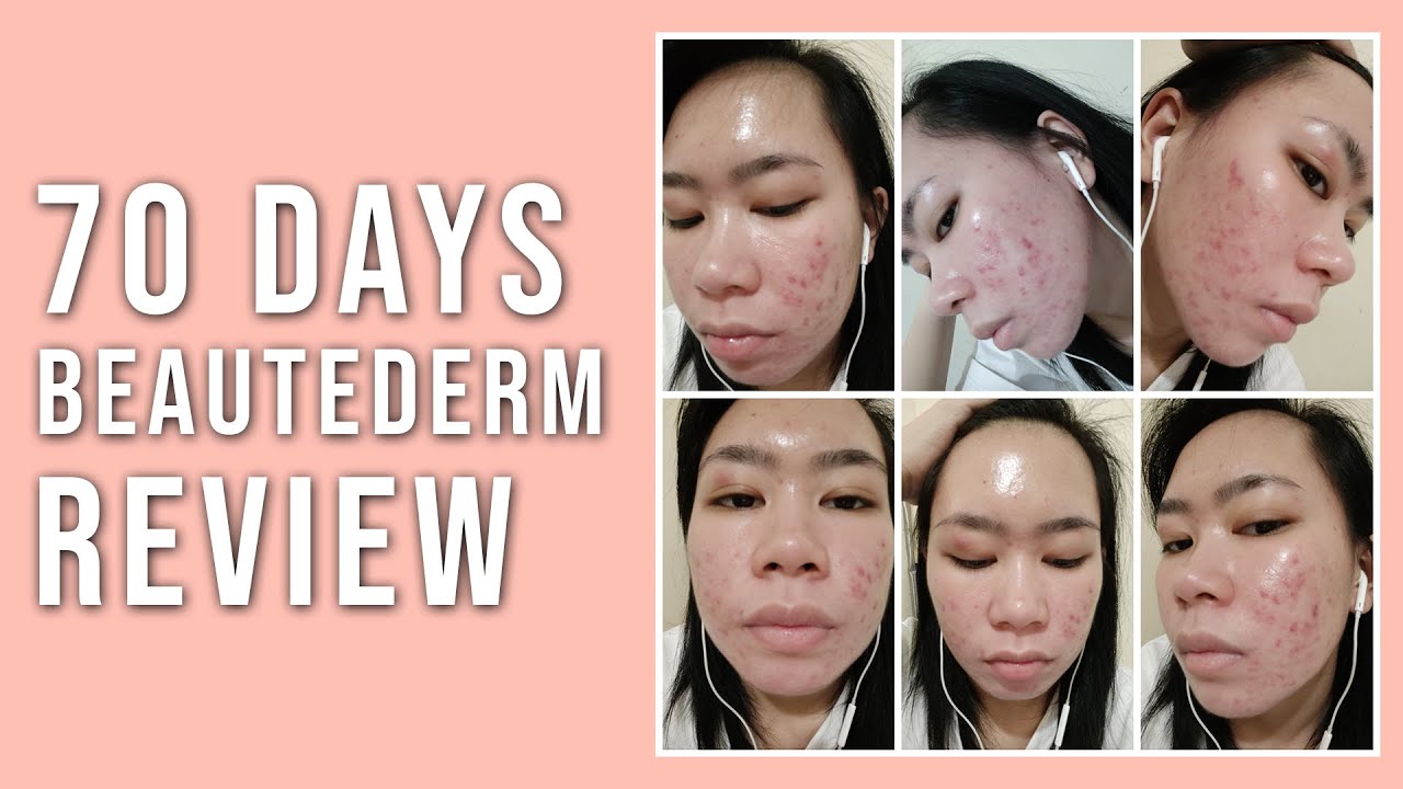 BEAUTEDERM REVIEW - 70 Days - YouTube