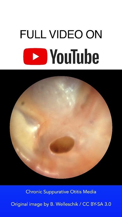 Chronic Suppurative Otitis Media Otoscopy - YouTube