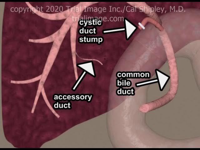 Common Hepatic Duct