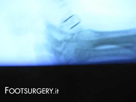 Alluce Rigido - radiografia animata - YouTube