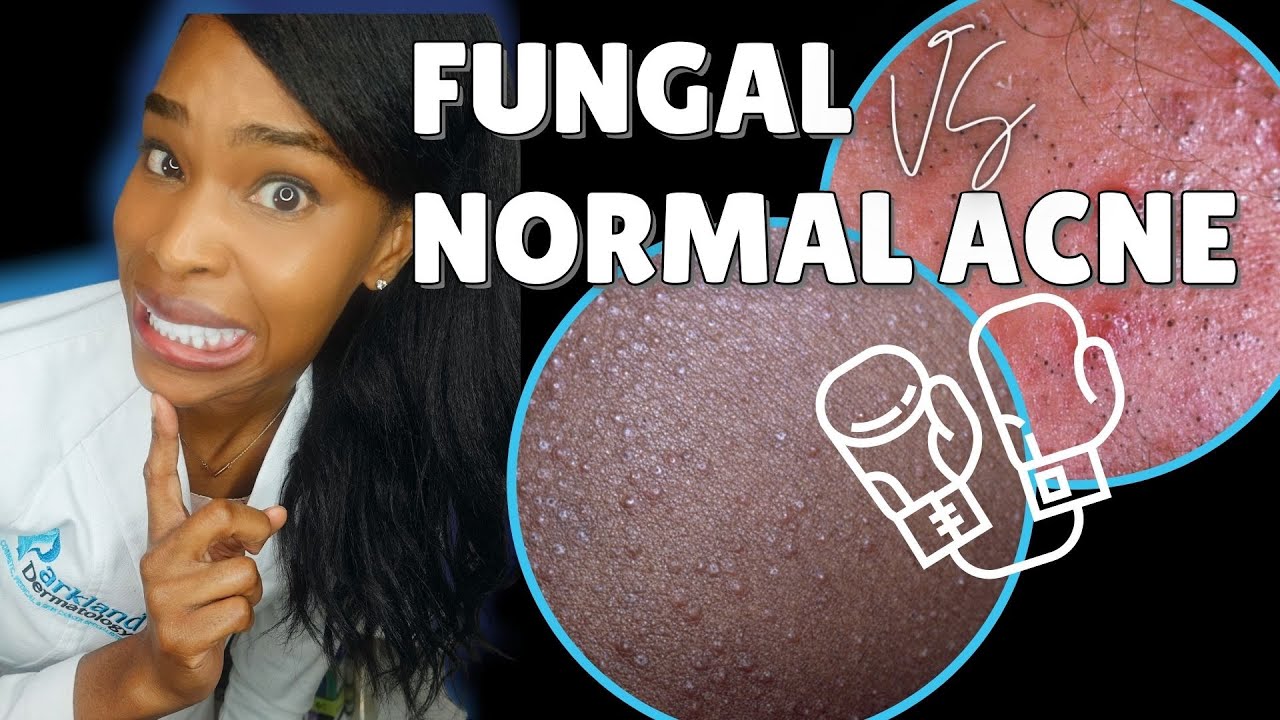FUNGAL ACNE vs NORMAL ACNE - YouTube
