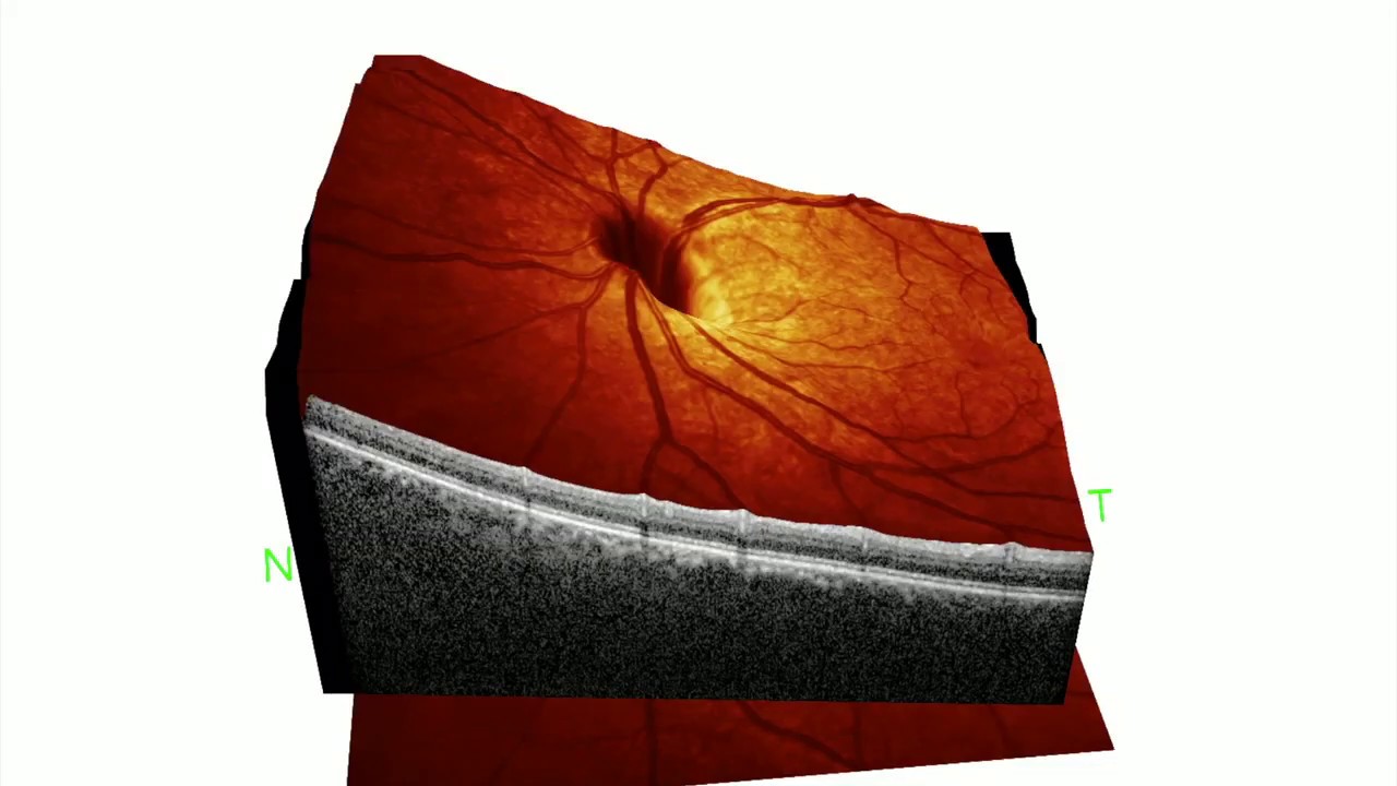 4D retinal imaging scan of the optic nerve head - YouTube