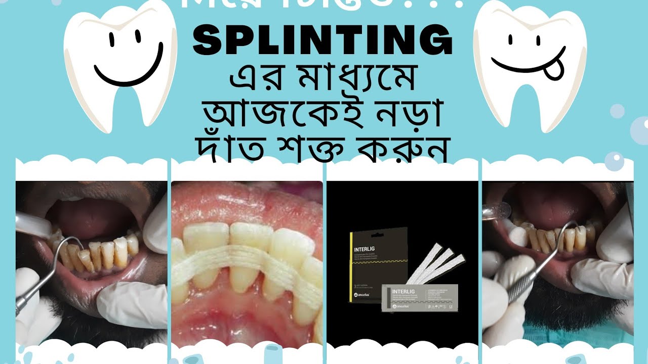 How to immobilize the mobile tooth by splinting. - YouTube