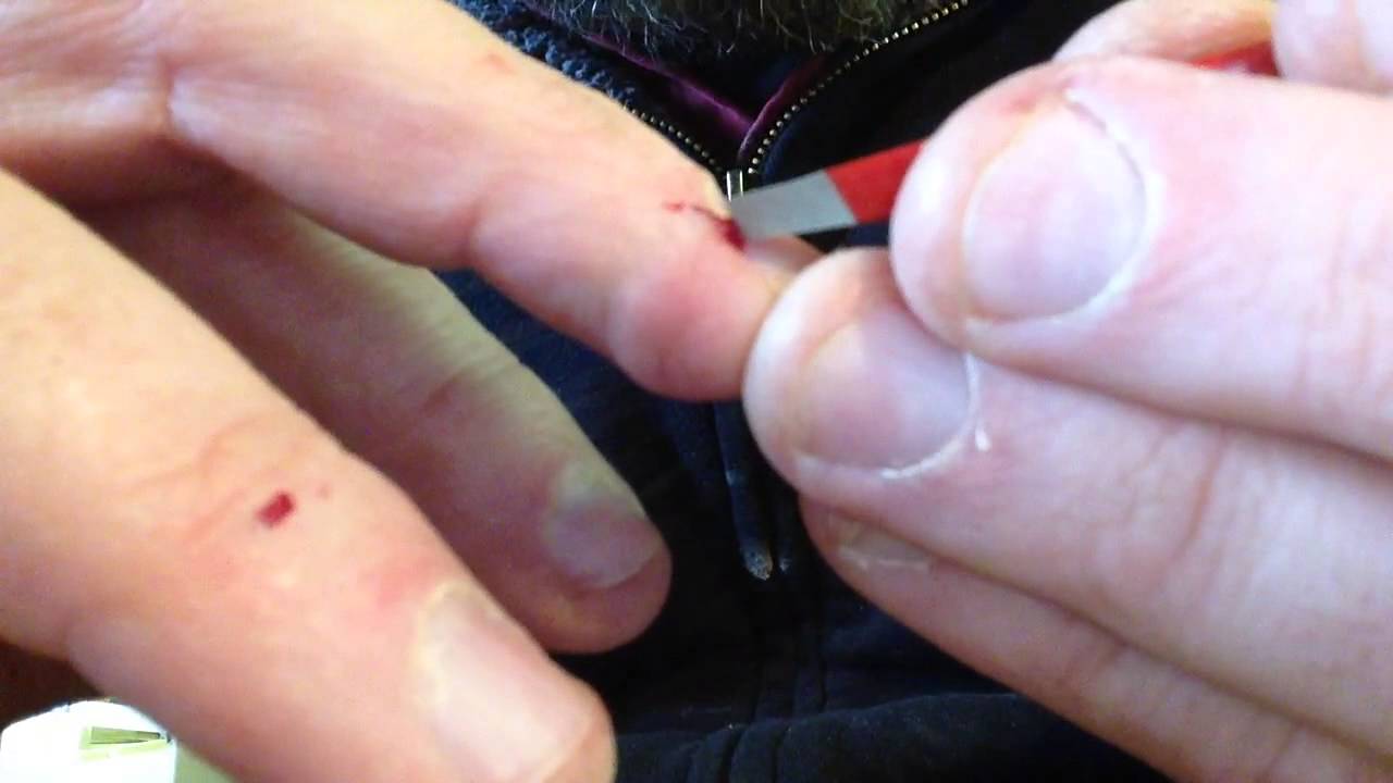 Splinter Extraction - YouTube