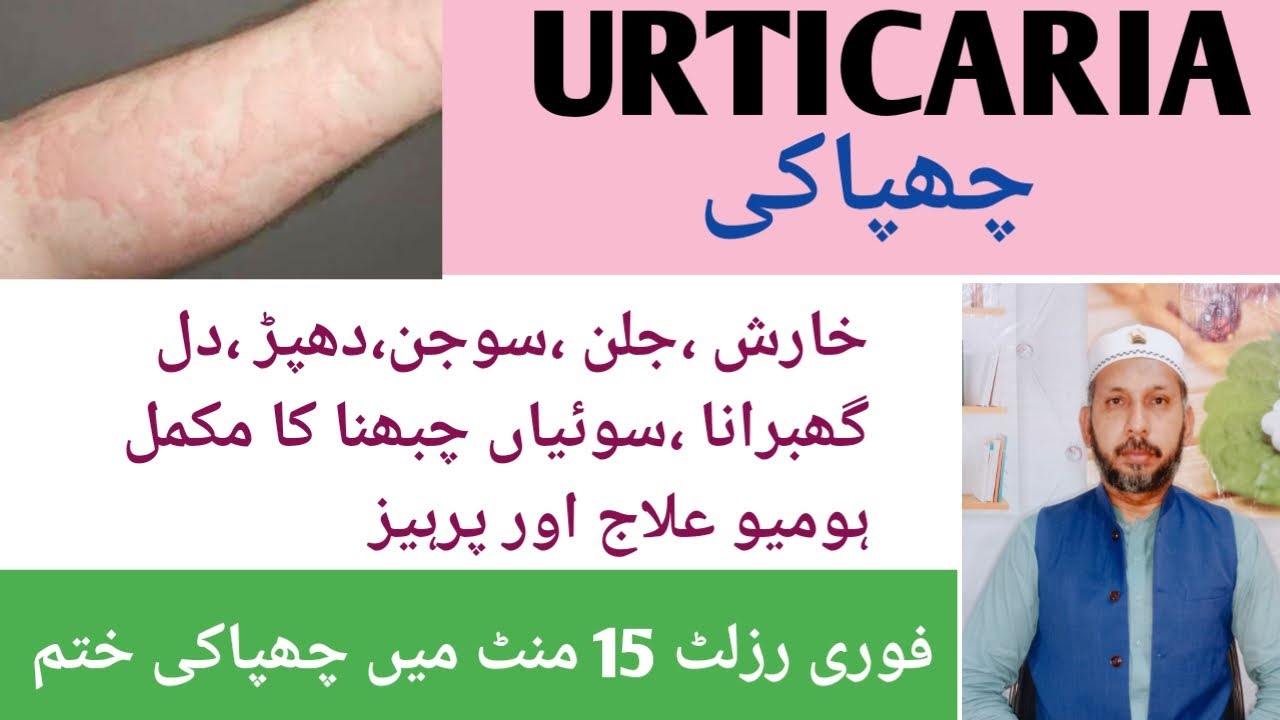 URTICARIA/ NETTLE RASH/ KHUJLI/ CHAPAKI/HOMEOPATHIC TREATMENT - YouTube