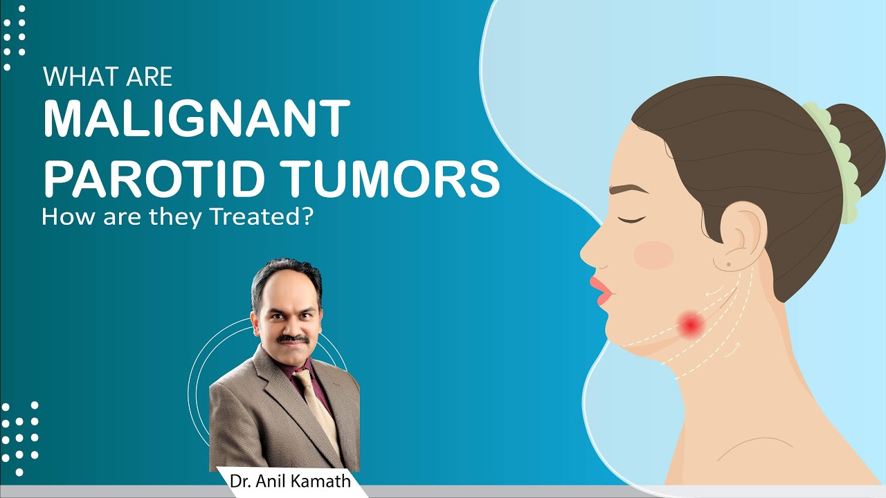 What are Malignant Parotid Tumors? | Malignant Parotid Tumor Treatment ...