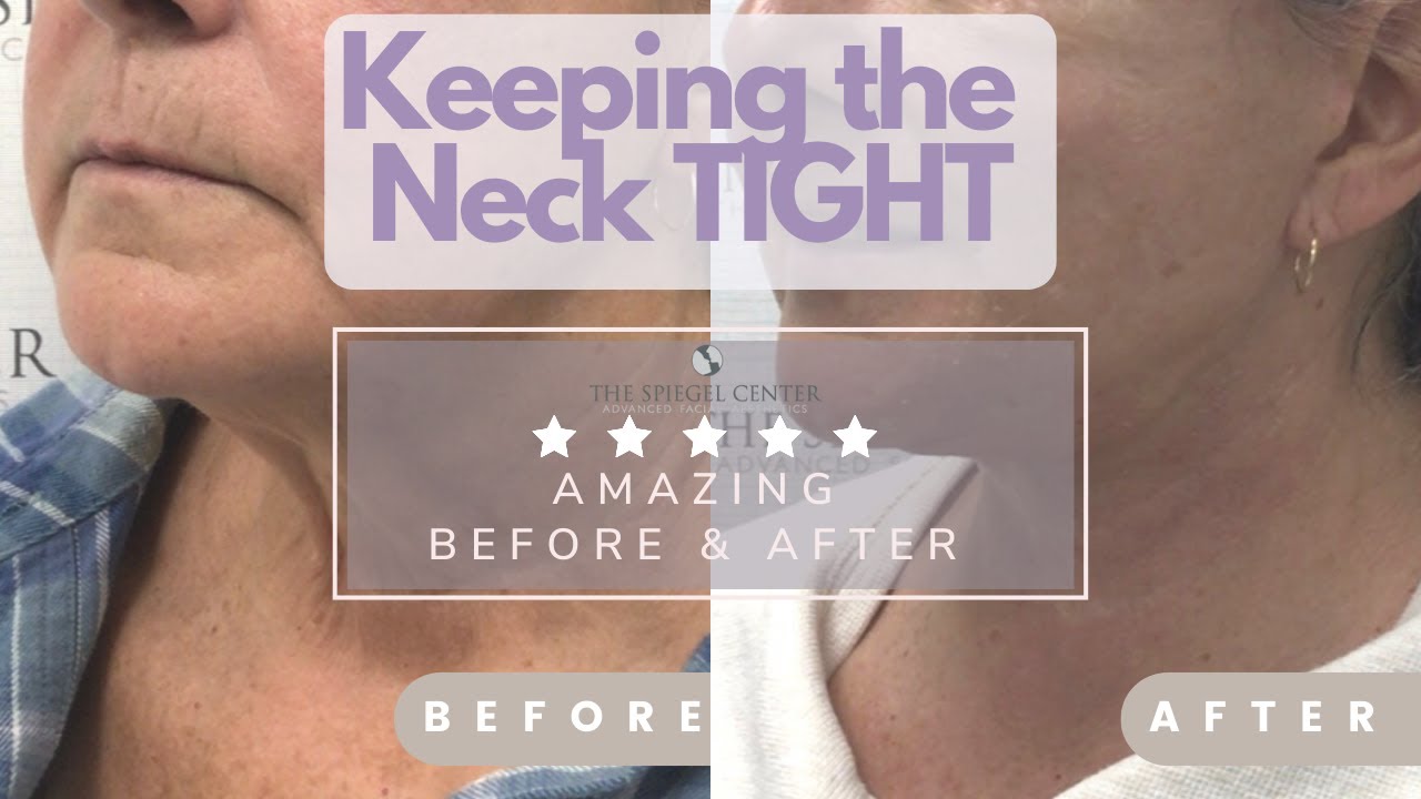 How to Keep the Neck Tight- Necklift with Dr. Jeffrey Spiegel - YouTube