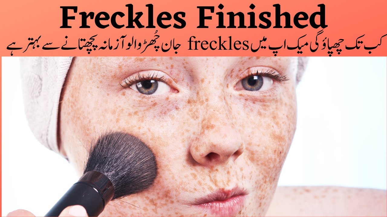 freckles removal treatment| how to remove freckles permanently - YouTube