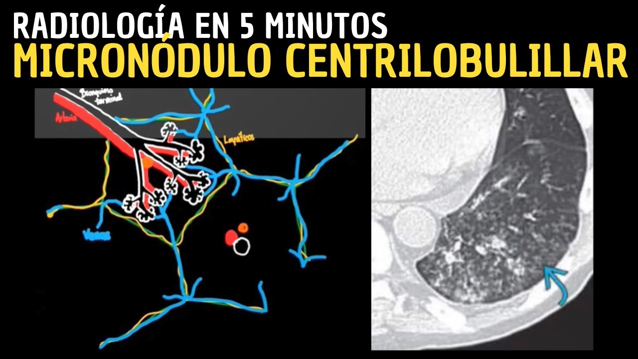 Radiología en 5 minutos: Signos radiológicos pulmonares: Micronódulo ...