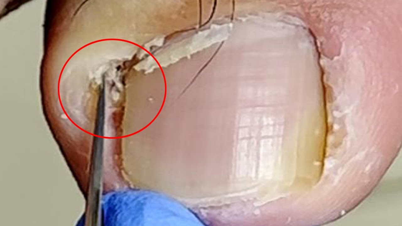 The ingrown toenail is about to become inflamed, and the patient came ...