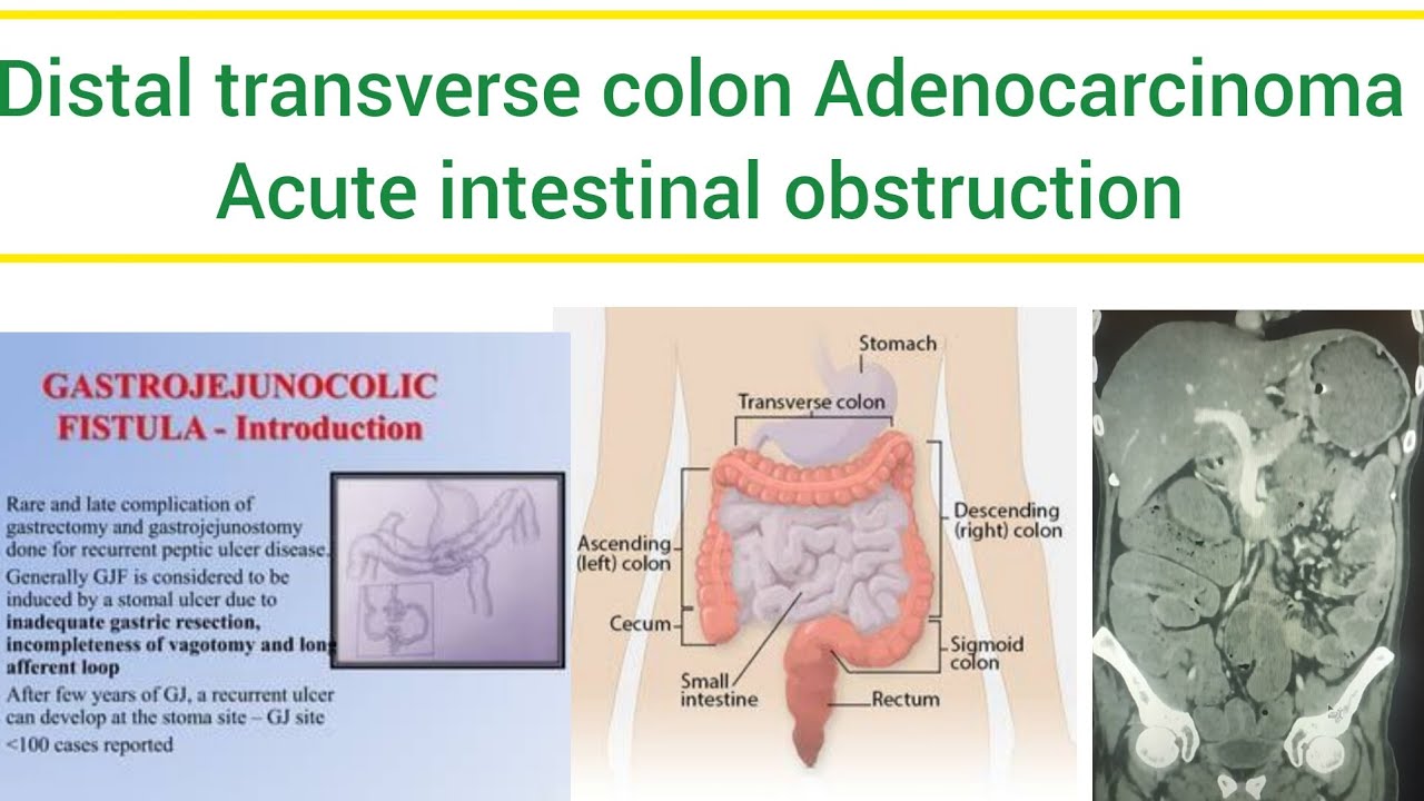 Distal transverse colon (Adenocarcinoma) with gastro colic fistula ...