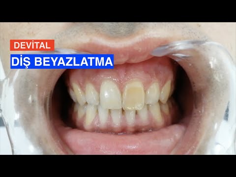Devital Diş Beyazlatma