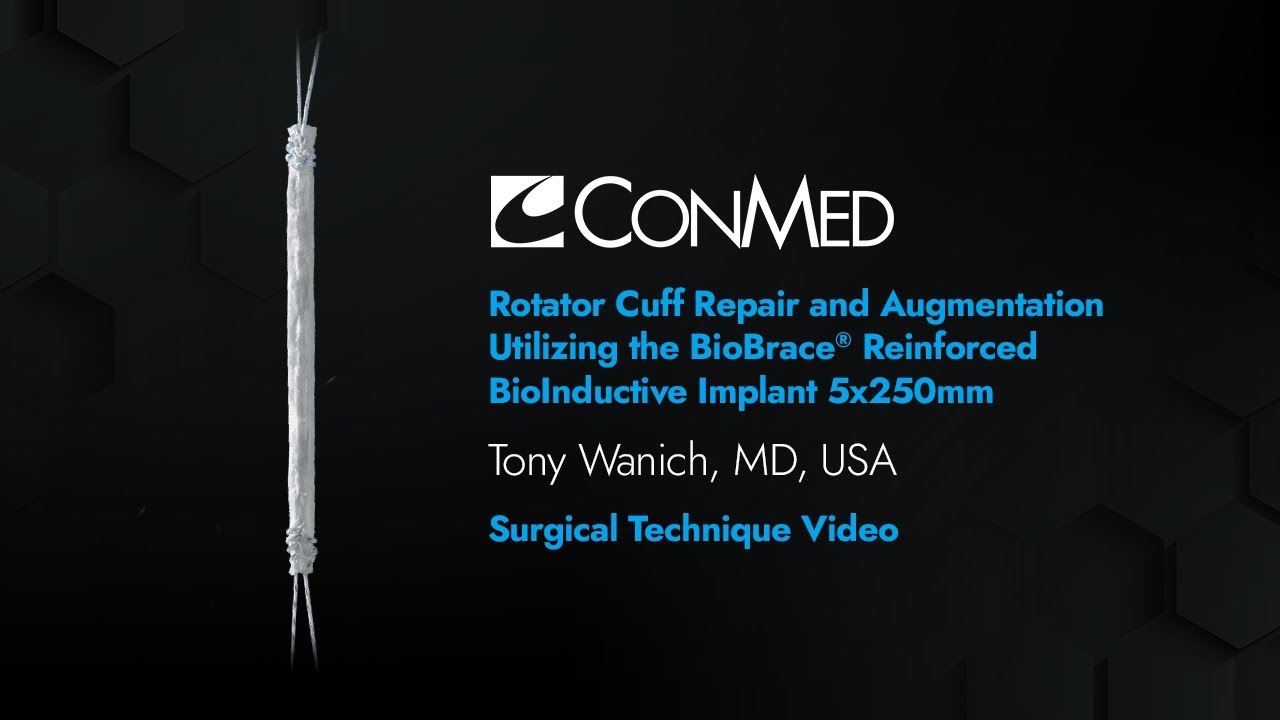 Rotator Cuff Augmentation Using the BioBrace® Reinforced Bioinductive ...