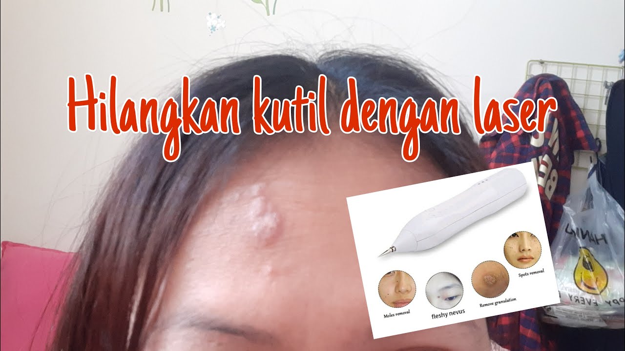 Cara Menggunakan Laser Penghilang Kutil & Tahi lalat - YouTube