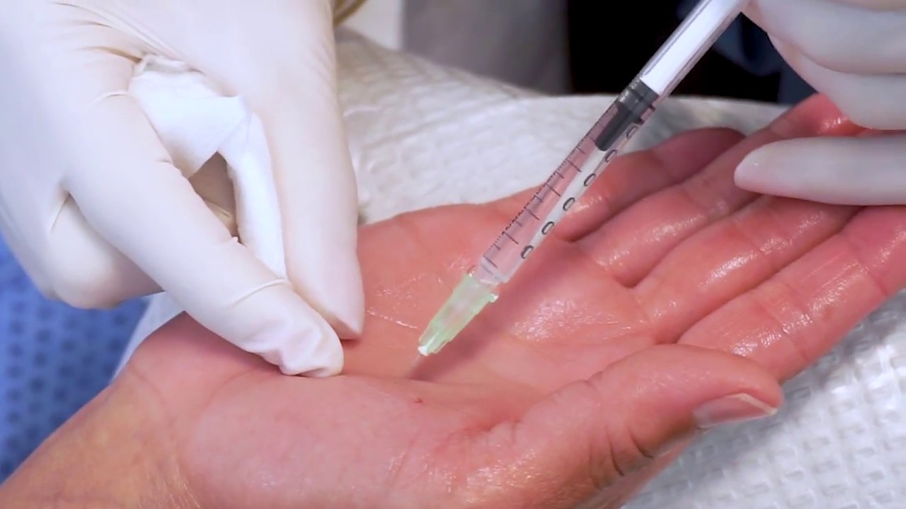 Botox For Excessively Sweaty Palms - YouTube