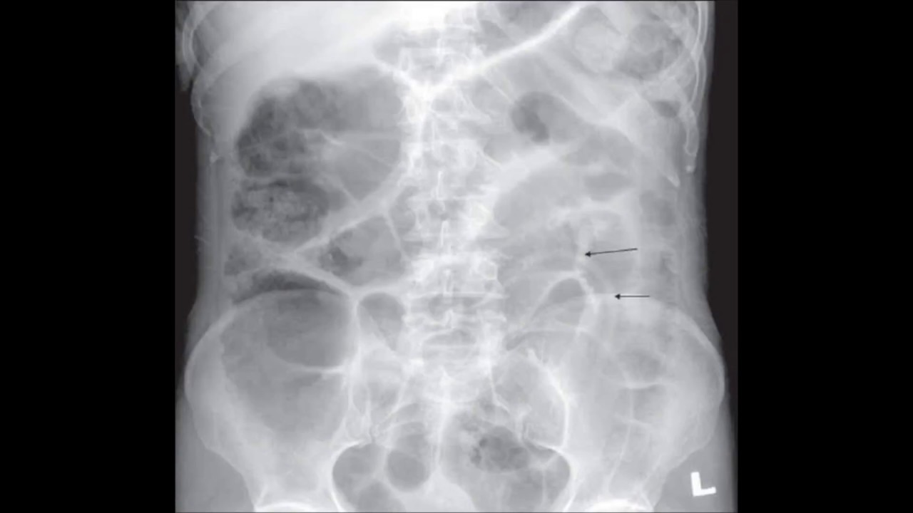 Ascariasis- causative agent, pathology, diagnosis and treatment - YouTube