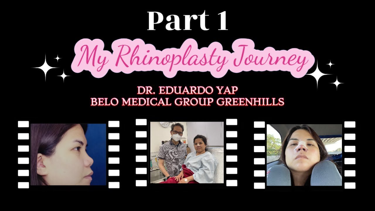 My Rhinoplasty Journey 👃🏻| Dr. Ed Yap Belo Medical Group 👨‍⚕️ | Yap ...