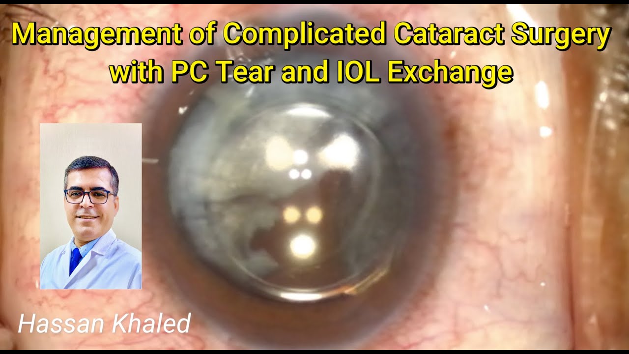Management of Complicated Cataract Surgery with PC tear and IOL ...