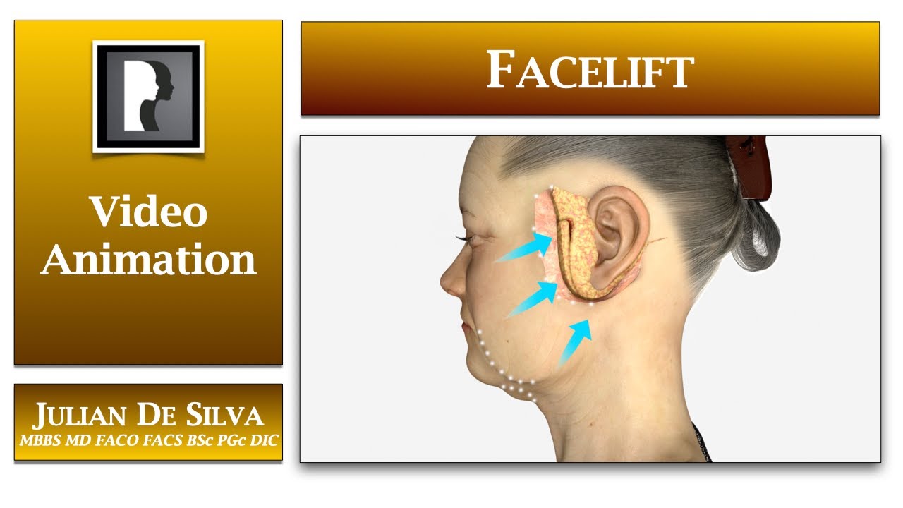 Facelift & Neck Lift Surgical Procedure: 3D medical animation by Dr ...