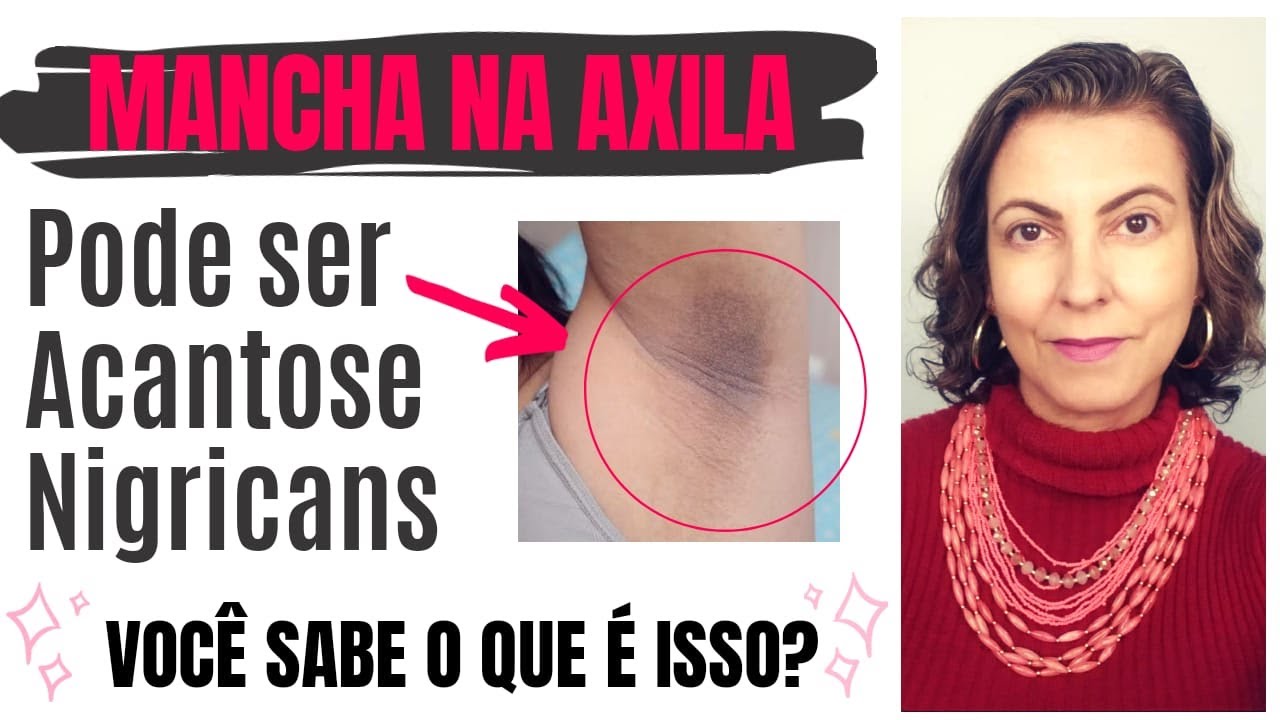 Acantose Nigricans Como Tratar - BRAINCP