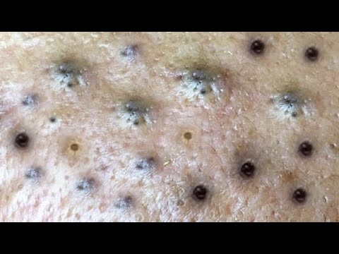 BLACKHEAD/ACNE REMOVAL FOR YOUUU !!! JUST CHILL AND RELAX With ...
