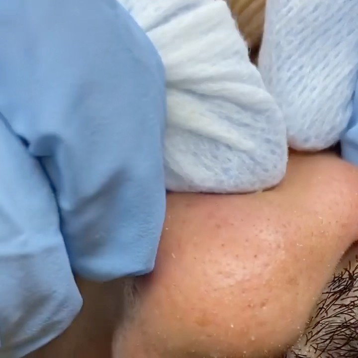 Men’s Nose Extractions - YouTube
