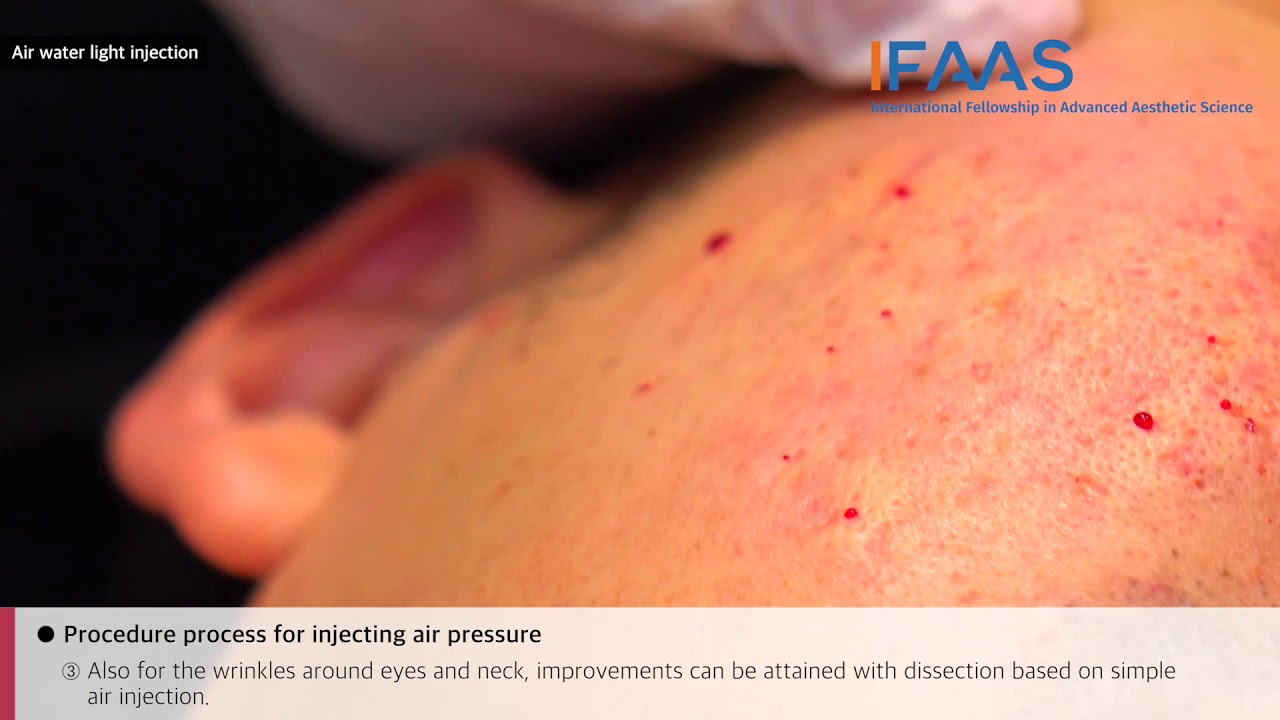 IFAAS Exclusive Training Video: Air Water Light Injection by Dr Han-Jin ...