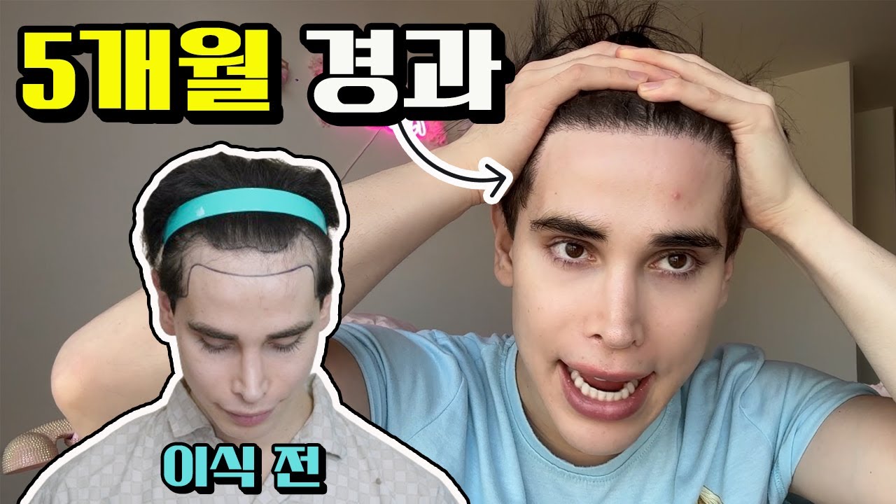 [비절개모발이식]틱톡(Tiktok) 43만(430K)인플루언서 ‘Santi Storm’ 헤어라인 모발이식 5개월 후기 - YouTube