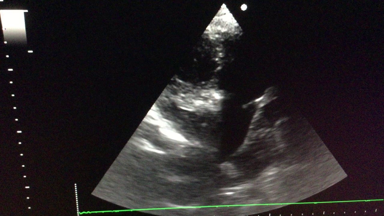 Echo Cardiography-RVOT Pulmonary valve.Alternative section TTE. - YouTube