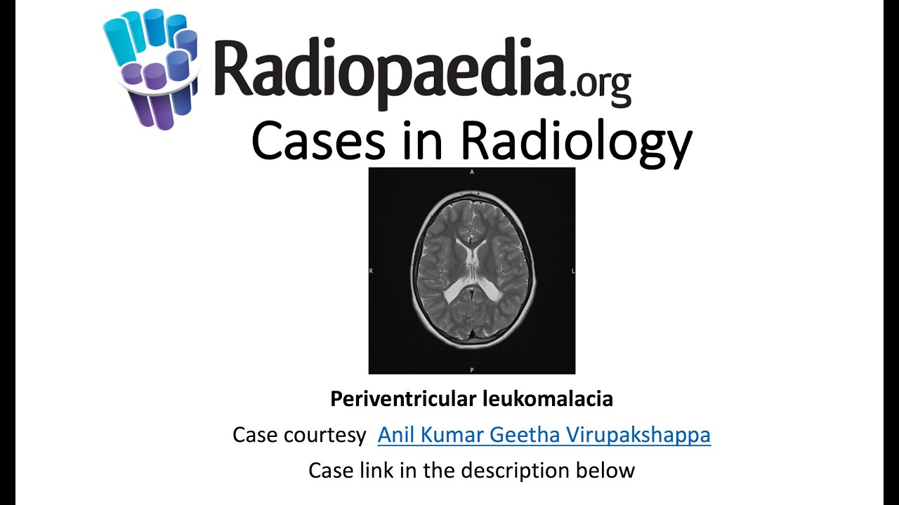 Periventricular leukomalacia (Radiopaedia.org) Cases in Radiology - YouTube