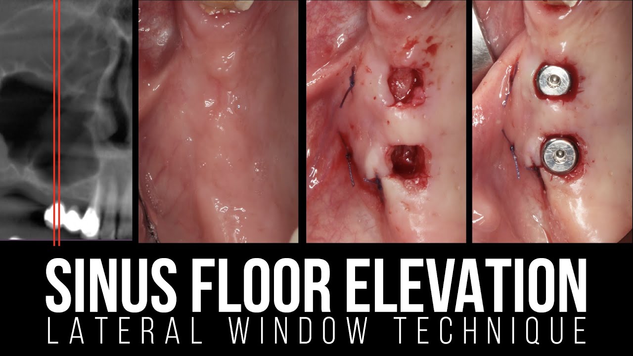 Maxillary Sinus Lift with Lateral Window Technique - YouTube